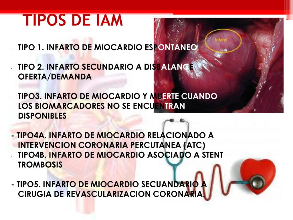 Ppt Infarto Agudo Al Miocardio Powerpoint Presentation Id4315168 ... Ppt Infarto Agudo Al Miocardio Powerpoint Presentation Id4315168 ...