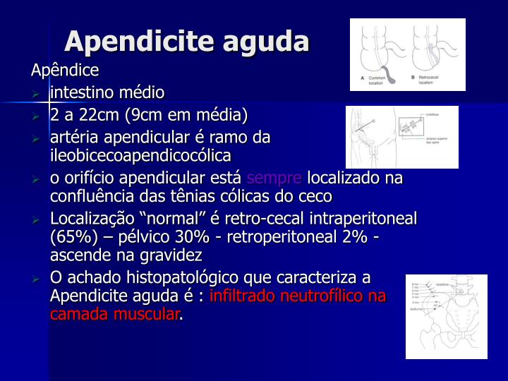 PPT - Apendicite Aguda PowerPoint Presentation - ID:4325092