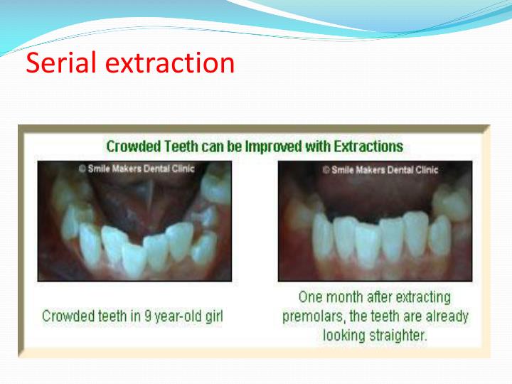 PPT - Serial extraction .. PowerPoint Presentation - ID:4327990