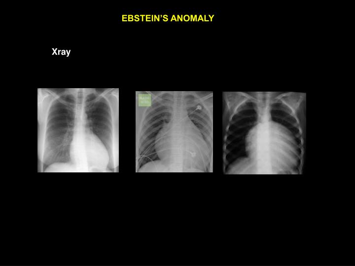 PPT - EBSTEIN'S ANOMALY OF TRICUSPID VALVE PowerPoint Presentation - ID:4346443