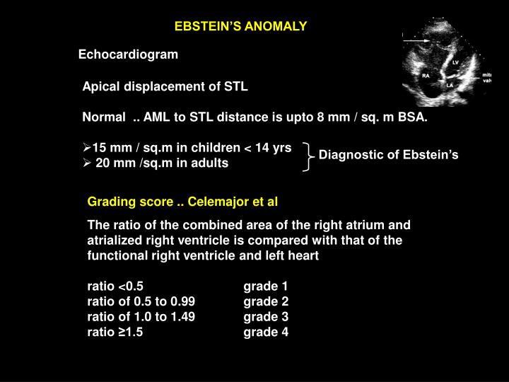 PPT - EBSTEIN'S ANOMALY OF TRICUSPID VALVE PowerPoint Presentation - ID ...