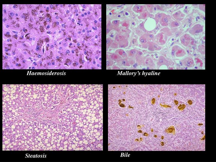 PPT - LIVER - Normal histology - Cirrhosis PowerPoint Presentation - ID ...