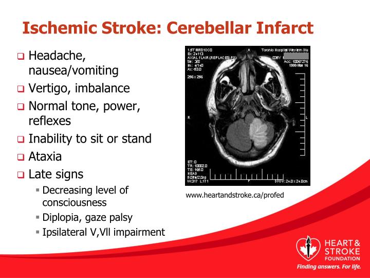 PPT - Types of Stroke PowerPoint Presentation - ID:4357751