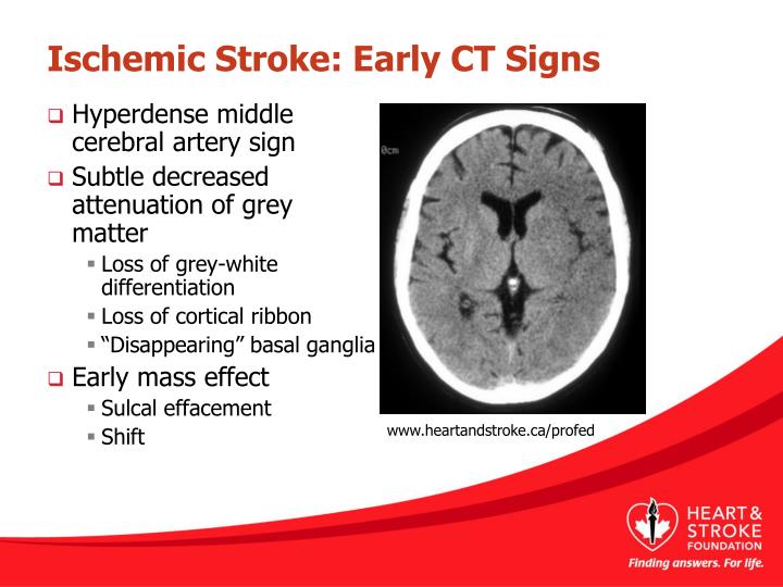 PPT - Types of Stroke PowerPoint Presentation - ID:4357751