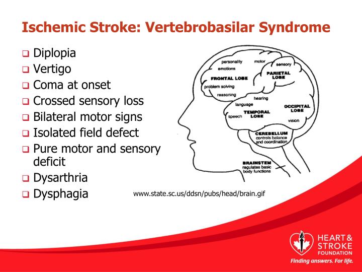 PPT - Types of Stroke PowerPoint Presentation - ID:4357751