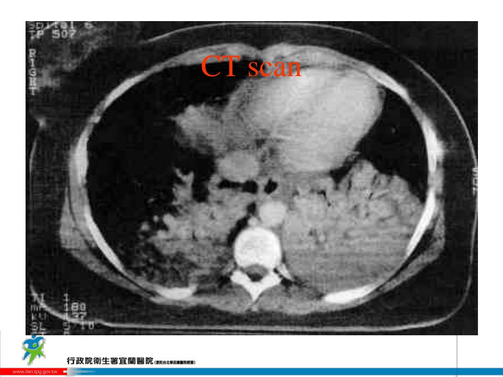 PPT - Prone position for Acute Respiratory Distress Syndrome PowerPoint ...
