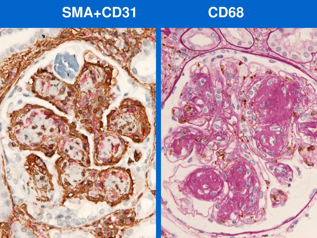 PPT - Heavy chain deposition disease in kidney biopsies PowerPoint ...