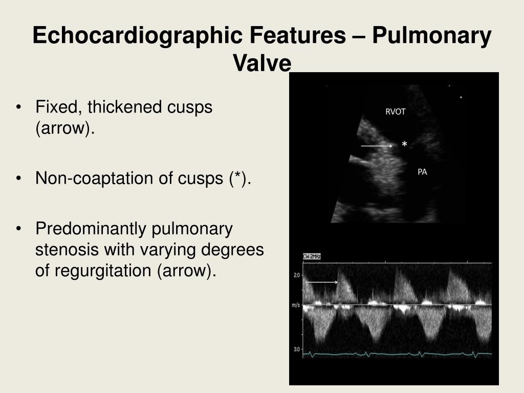 PPT - British Heart Valve Society Carcinoid Heart Disease PowerPoint ... PPT - British Heart Valve Society Carcinoid Heart Disease PowerPoint ...
