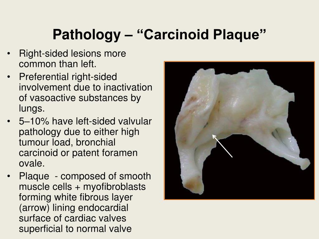 PPT - British Heart Valve Society Carcinoid Heart Disease PowerPoint ... PPT - British Heart Valve Society Carcinoid Heart Disease PowerPoint ...