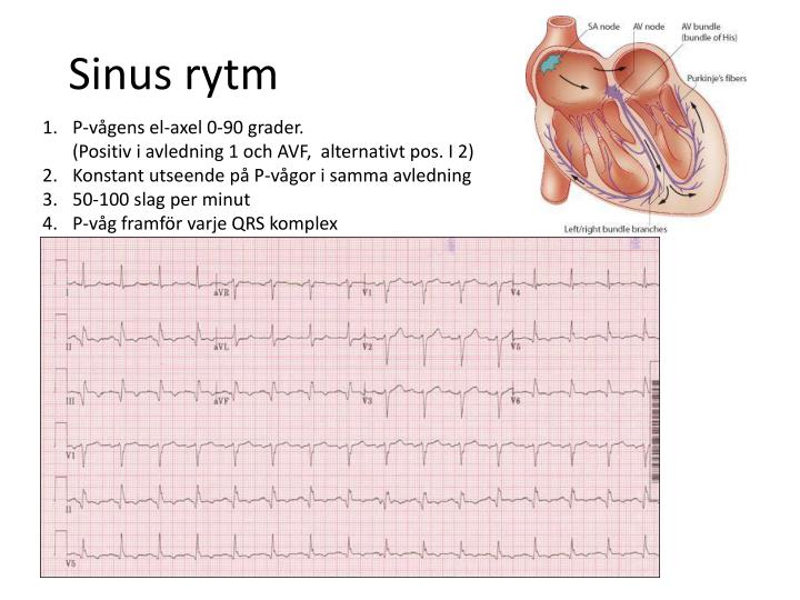 PPT - EKG på svenska! PowerPoint Presentation - ID:4369761