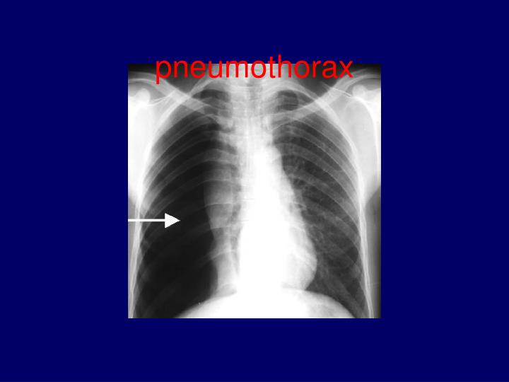 PPT - Appareil Respiratoire PowerPoint Presentation - ID:4380884