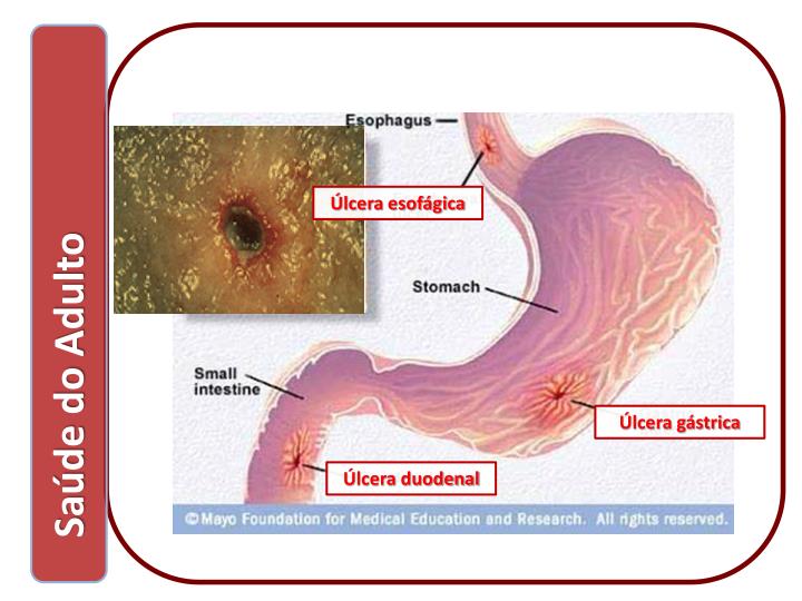 PPT - Úlcera Péptica PowerPoint Presentation - ID:4386161