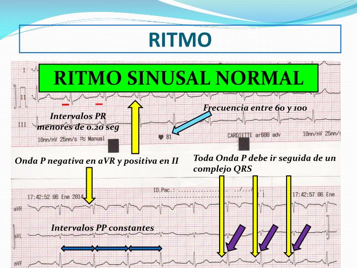 PPT - Lectura e interpretación del electrocardiograma PowerPoint ...