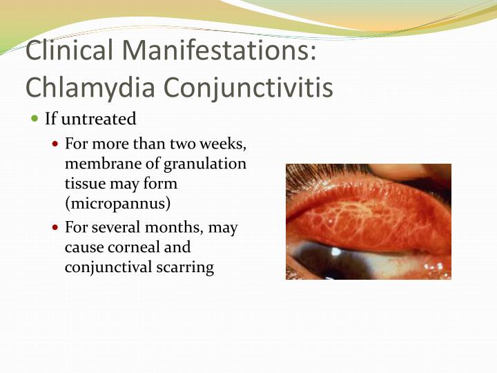 PPT - Chlamydia in the Newborn PowerPoint Presentation - ID:4395690