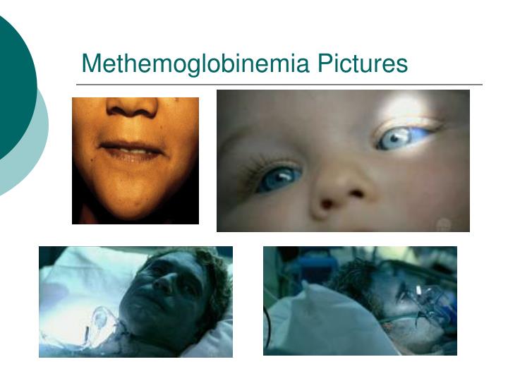 PPT - Methemoglobinemia: The real cause of the Blue People of Kentucky ...