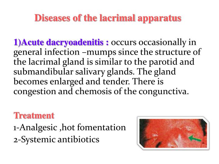 PPT - Anatomy and diseases of lacrimal apparatus PowerPoint ...