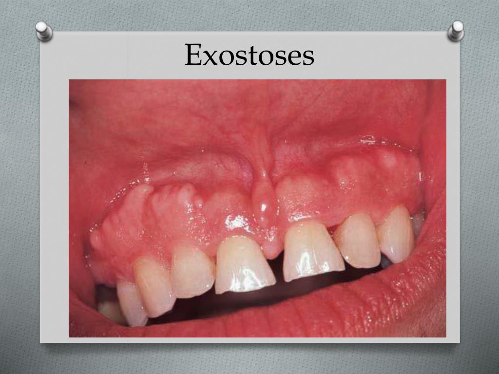 PPT - Anomalies et malformations congénitales PowerPoint Presentation ...