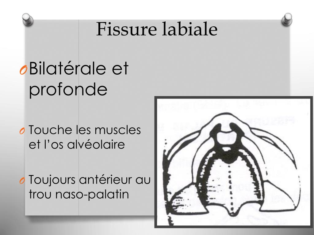 PPT - Anomalies et malformations congénitales PowerPoint Presentation ...