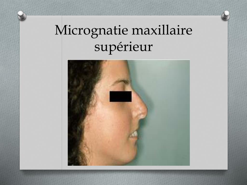 PPT - Anomalies et malformations congénitales PowerPoint Presentation ...