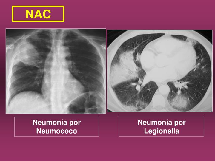 PPT - INFECCIONES RESPIRATORIAS PowerPoint Presentation - ID:4404841