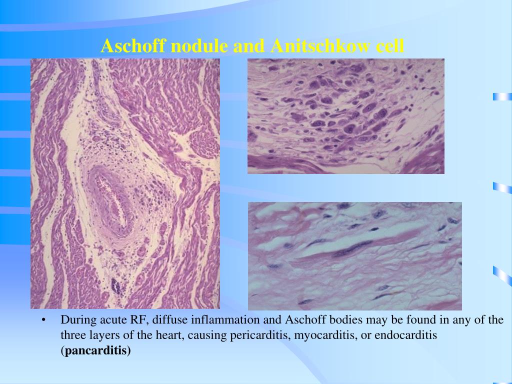 PPT - Pathology of rheumatic fever, IE & Valvular diseases DR. AMMAR AL ...