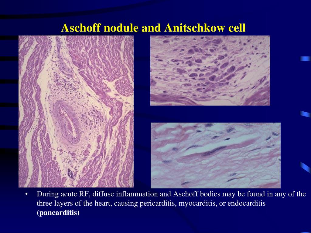PPT - Pathology of rheumatic fever, IE & Valvular diseases DR. AMMAR AL ...
