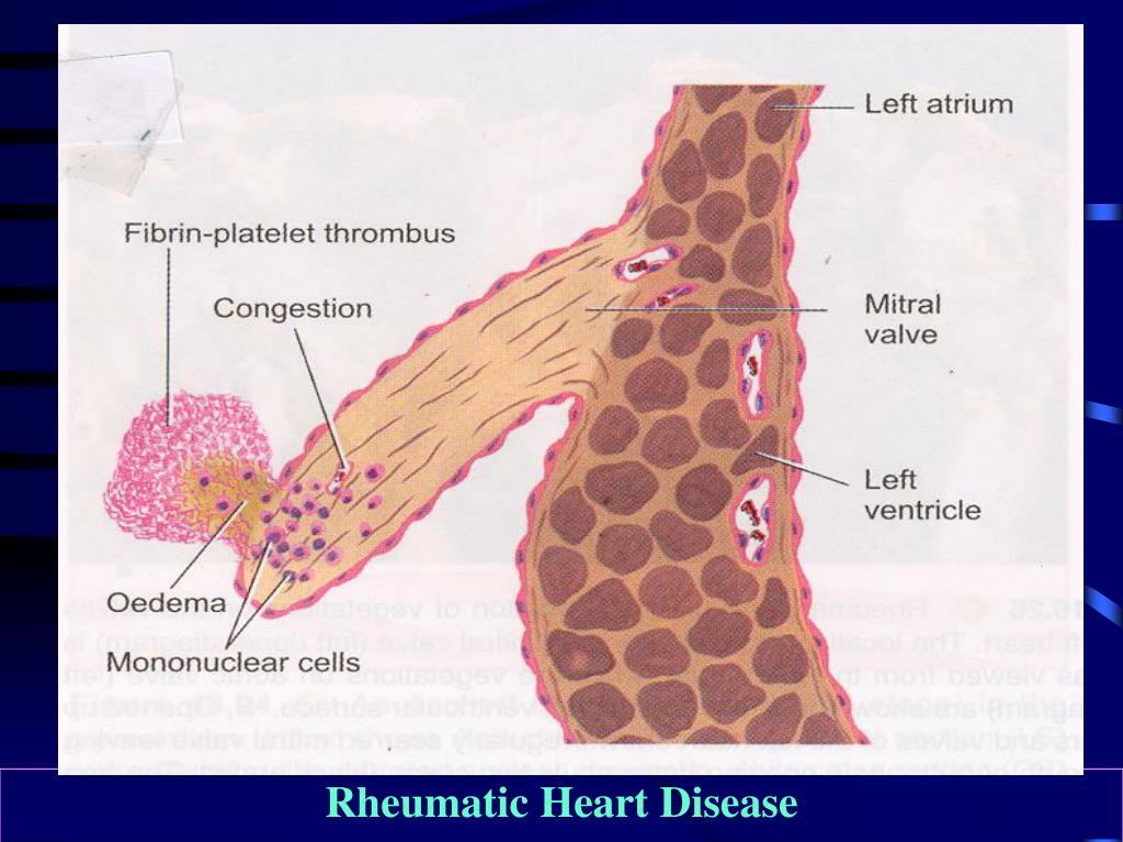 PPT - Pathology of rheumatic fever, IE & Valvular diseases DR. AMMAR AL ...