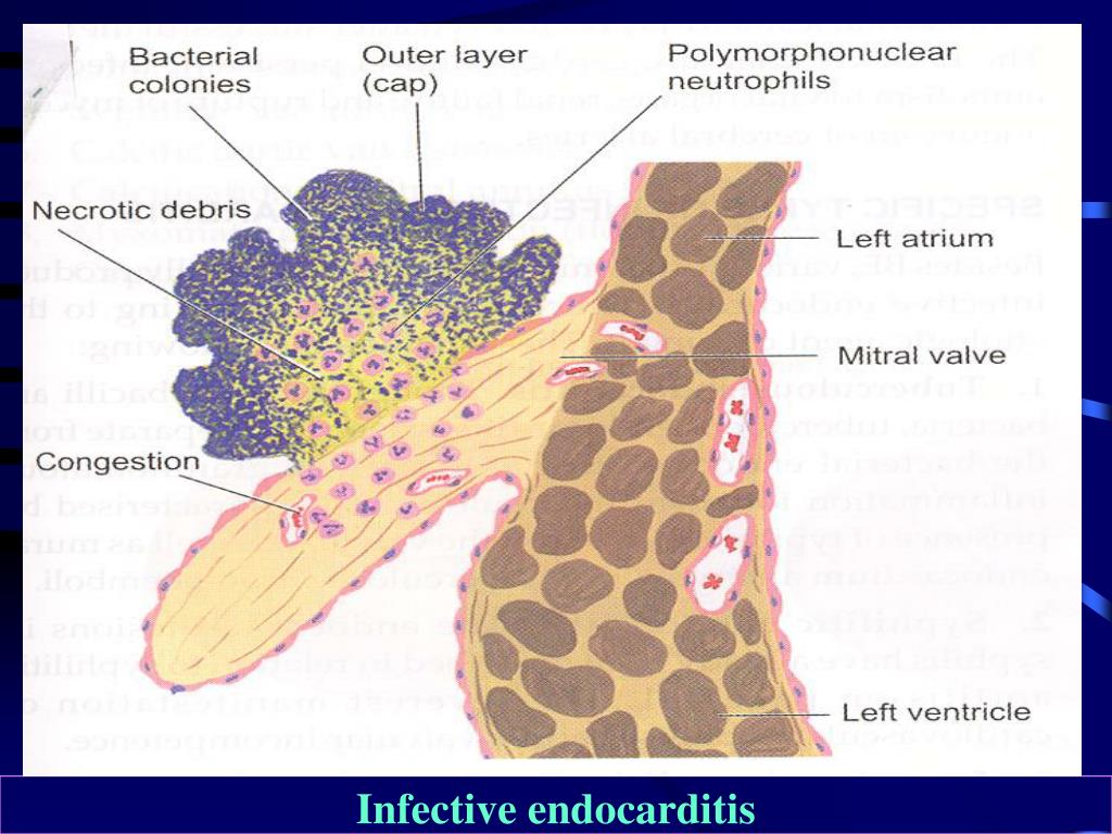 PPT - Pathology of rheumatic fever, IE & Valvular diseases DR. AMMAR AL ...