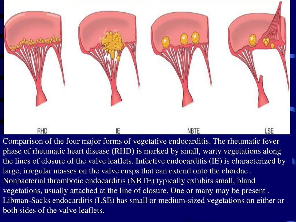 PPT - Pathology of rheumatic fever, IE & Valvular diseases DR. AMMAR AL ...