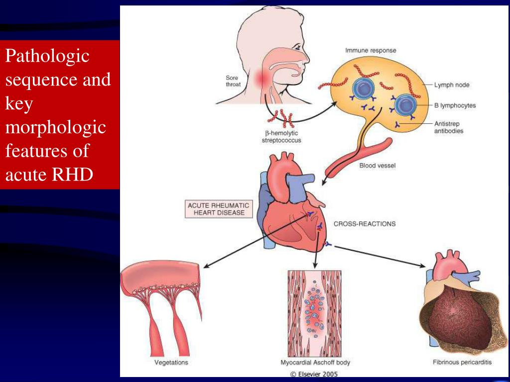 PPT - Pathology of rheumatic fever, IE & Valvular diseases DR. AMMAR AL ...