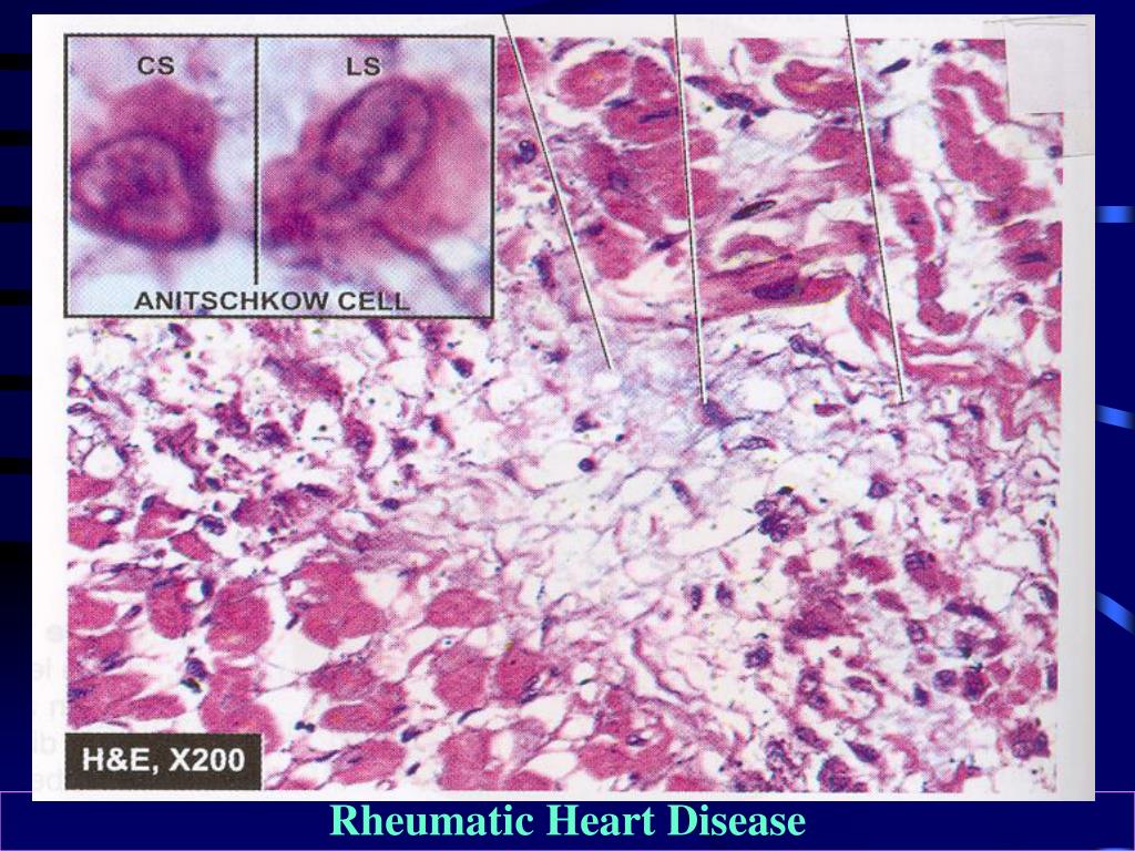 PPT - Pathology of rheumatic fever, IE & Valvular diseases DR. AMMAR AL ...