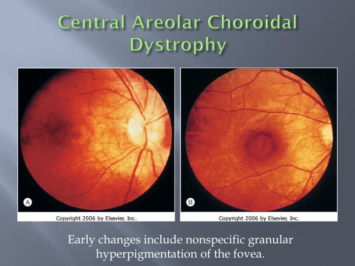 PPT - Hereditary Choroidal Disease PowerPoint Presentation - ID:4411245