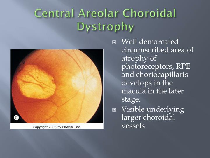 PPT - Hereditary Choroidal Disease PowerPoint Presentation - ID:4411245