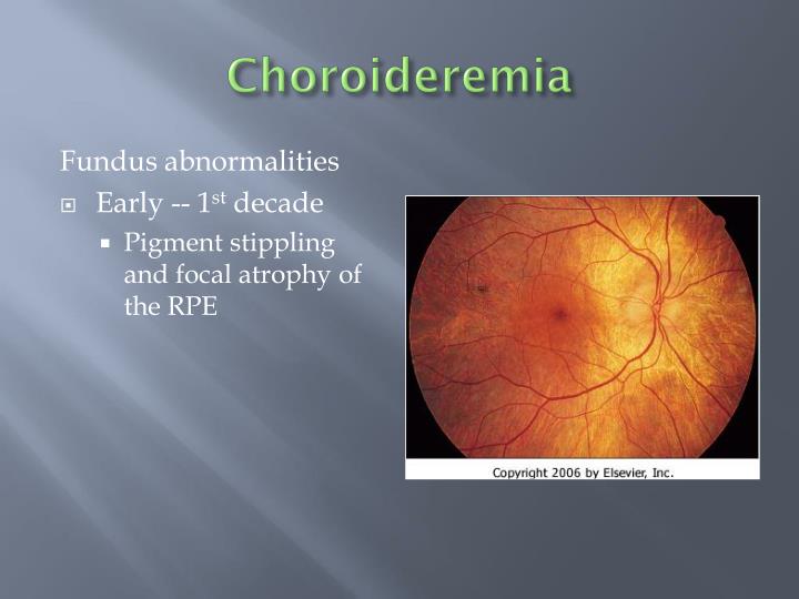 PPT - Hereditary Choroidal Disease PowerPoint Presentation - ID:4411245