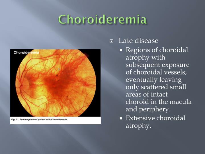 PPT - Hereditary Choroidal Disease PowerPoint Presentation - ID:4411245