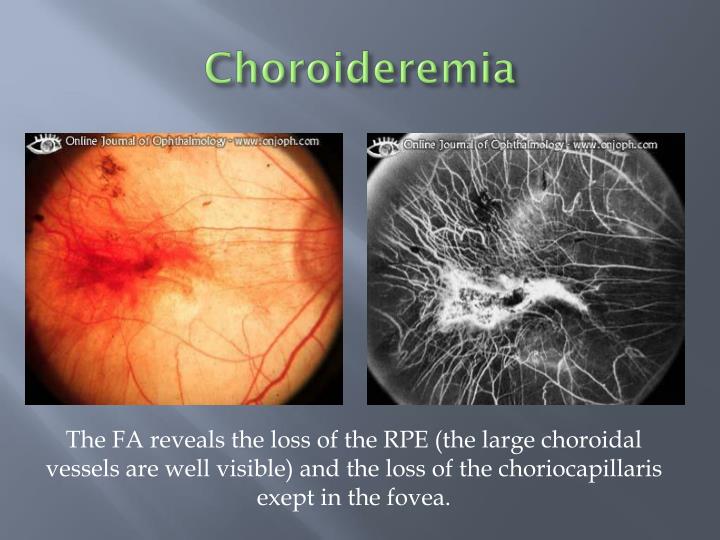PPT - Hereditary Choroidal Disease PowerPoint Presentation - ID:4411245
