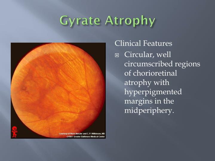 PPT - Hereditary Choroidal Disease PowerPoint Presentation - ID:4411245