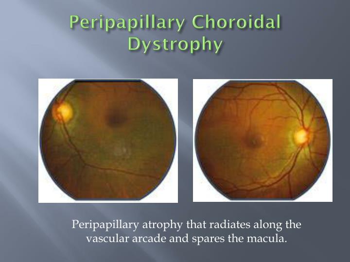 PPT - Hereditary Choroidal Disease PowerPoint Presentation - ID:4411245