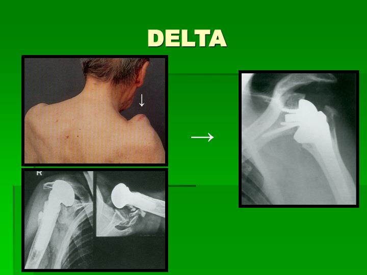 PPT - Shoulder Arthroplasty PowerPoint Presentation - ID:4419492