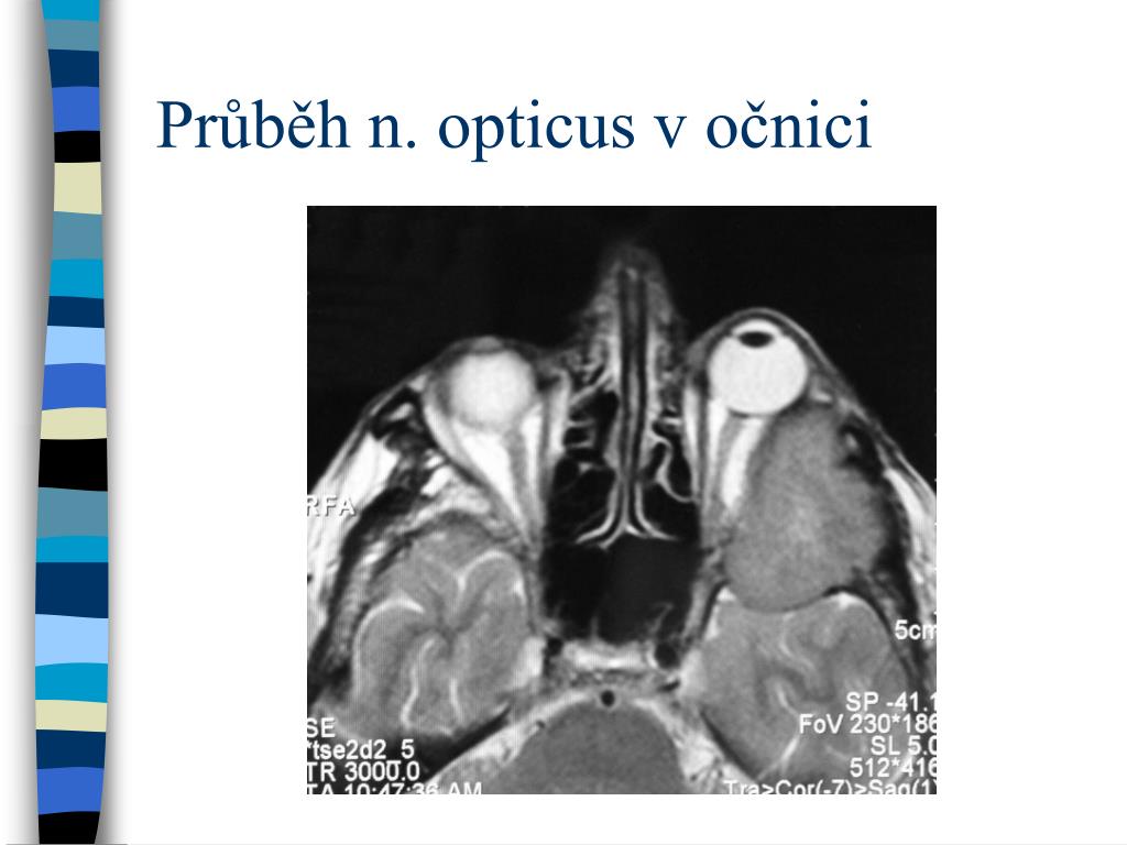 PPT - Anatomie a fyziologie oka III. PowerPoint Presentation, free ...