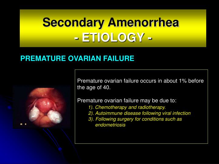 PPT - SECONDARY AMENORRHEA PowerPoint Presentation - ID:4428677