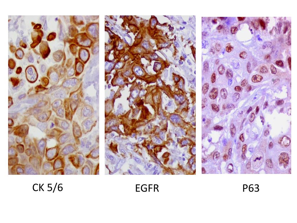 PPT - Carcinoma de Mama de Tipo Basal PowerPoint Presentation, free ...