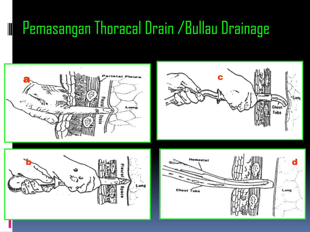 PPT - Pneumotoraks Arimbi,Sp.P Ilmu Penyakit Dalam FK UWKS 2012 ...