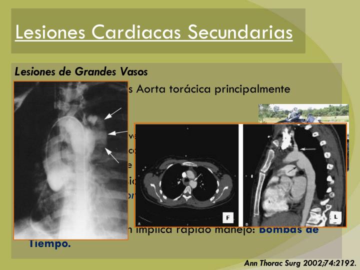 PPT - Trauma Cardiaco PowerPoint Presentation - ID:4449575