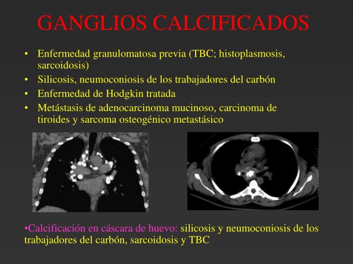 PPT - ASPECTO DE LOS GANGLIOS POR TC PowerPoint Presentation - ID:4451402