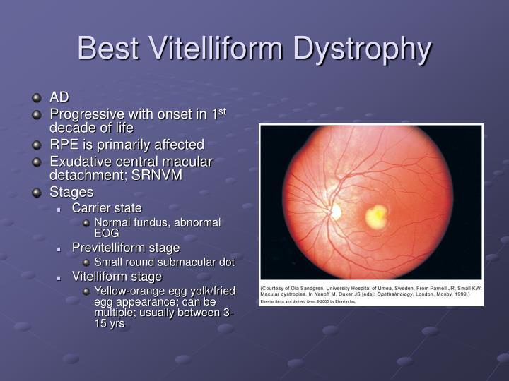 PPT - Vitreous and Retina Pediatric Ophthalmology PowerPoint ...