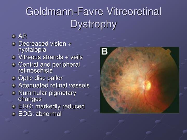 PPT - Vitreous and Retina Pediatric Ophthalmology PowerPoint ...