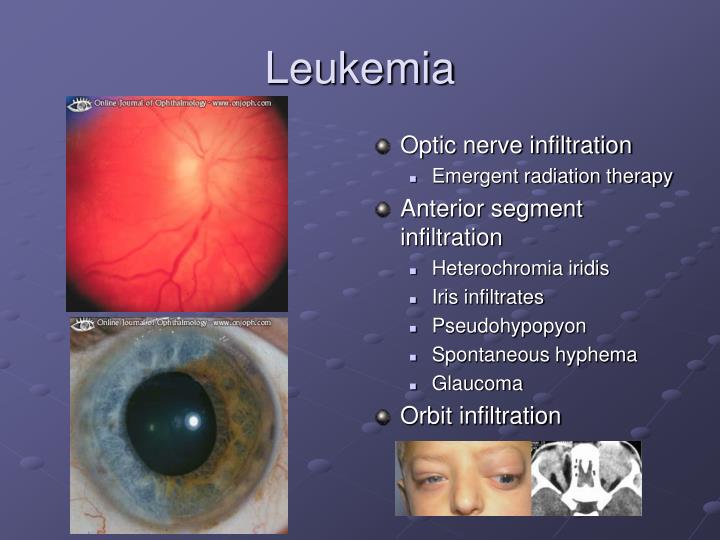 PPT - Vitreous and Retina Pediatric Ophthalmology PowerPoint ...