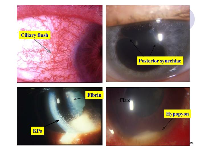 PPT - RED EYE PowerPoint Presentation - ID:4462263