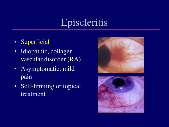 PPT - The Red Eye PowerPoint Presentation - ID:4462658